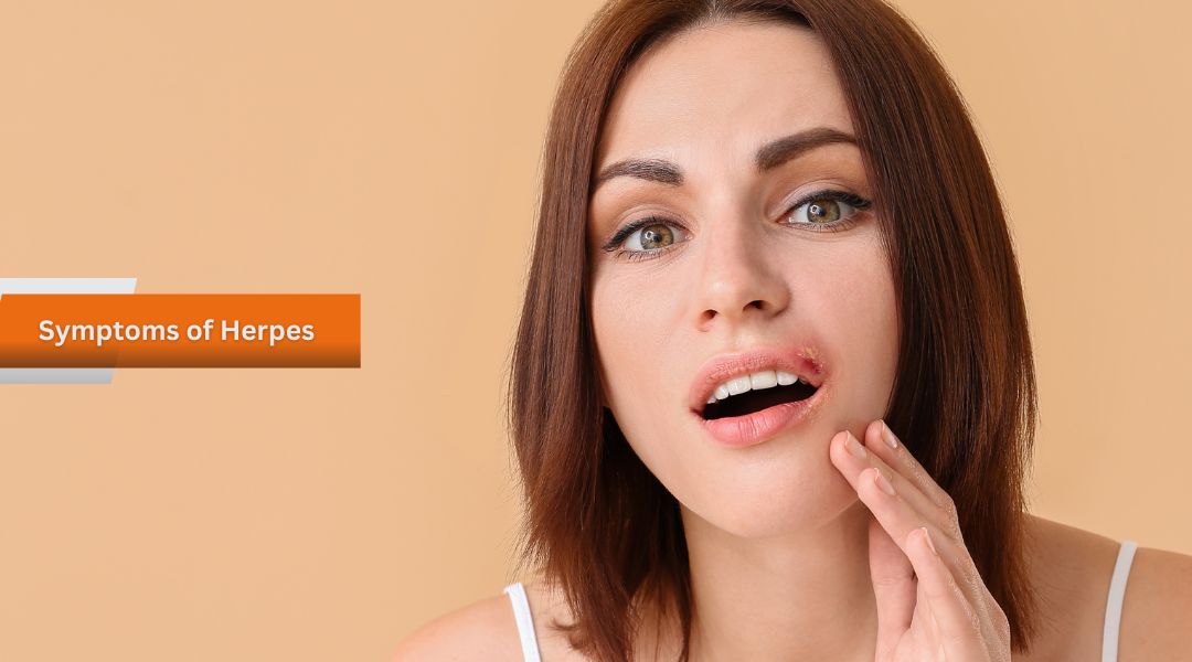 Herpes : Causes Symptoms Treatment Prevention | The HIV Map.